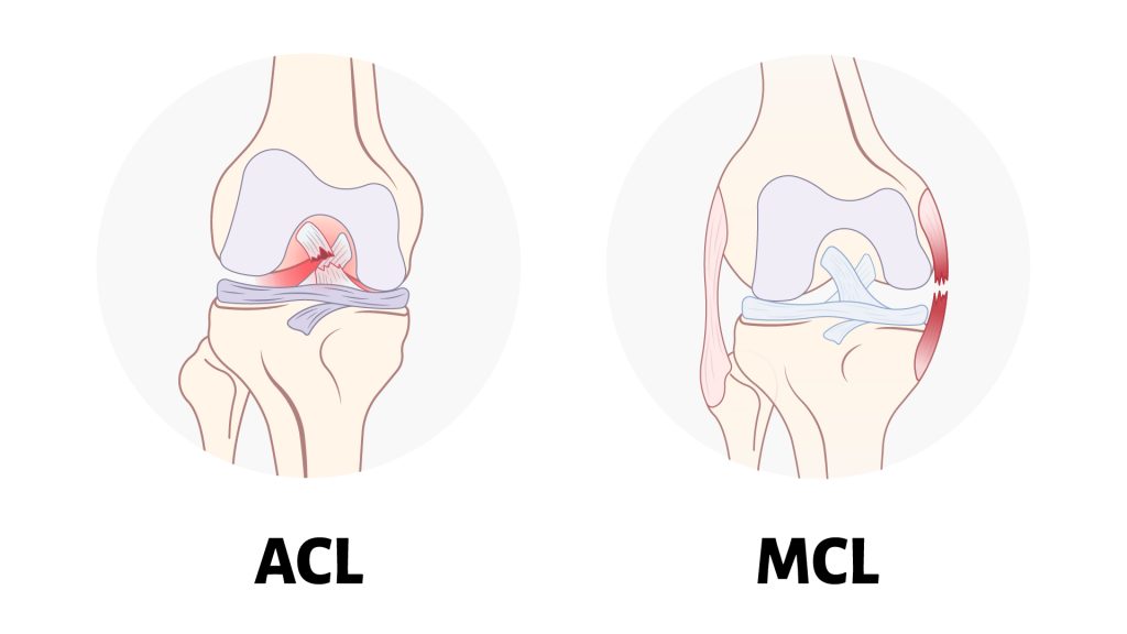 Love Your Ligaments: Tips for Preventing ACL and MCL Injuries | Charlotte Radiology