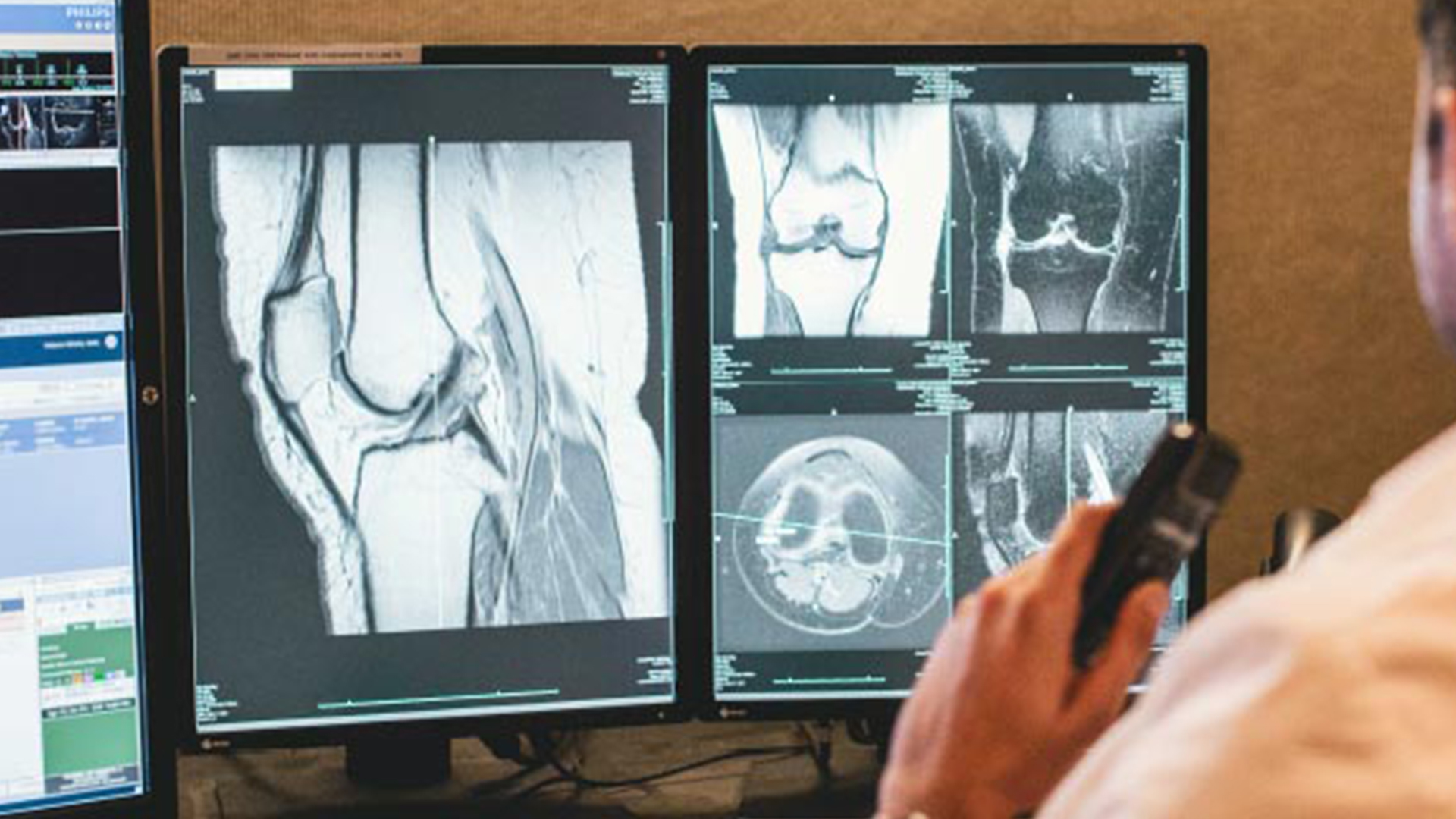 Love Your Ligaments: Tips for Preventing ACL and MCL Injuries ...